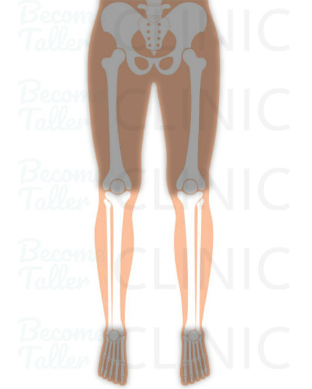 Limb Lengthening Surgery Pricing - Become Taller Clinic