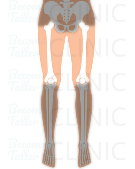 Limb Lengthening Surgery Pricing - Become Taller Clinic